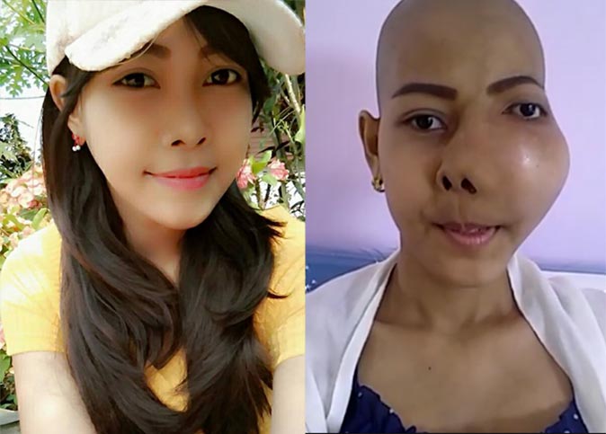Formerly gorgeous girl deformed by facial cancer defends before-and ...